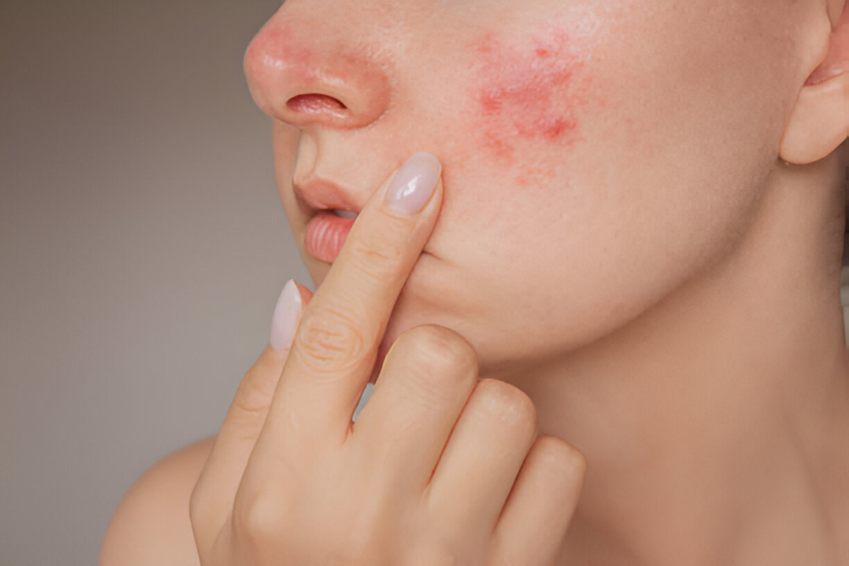 Acne Removal Treatments - Theme Dermatology